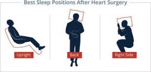 Best Sleeping Positions after Open Heart Surgery